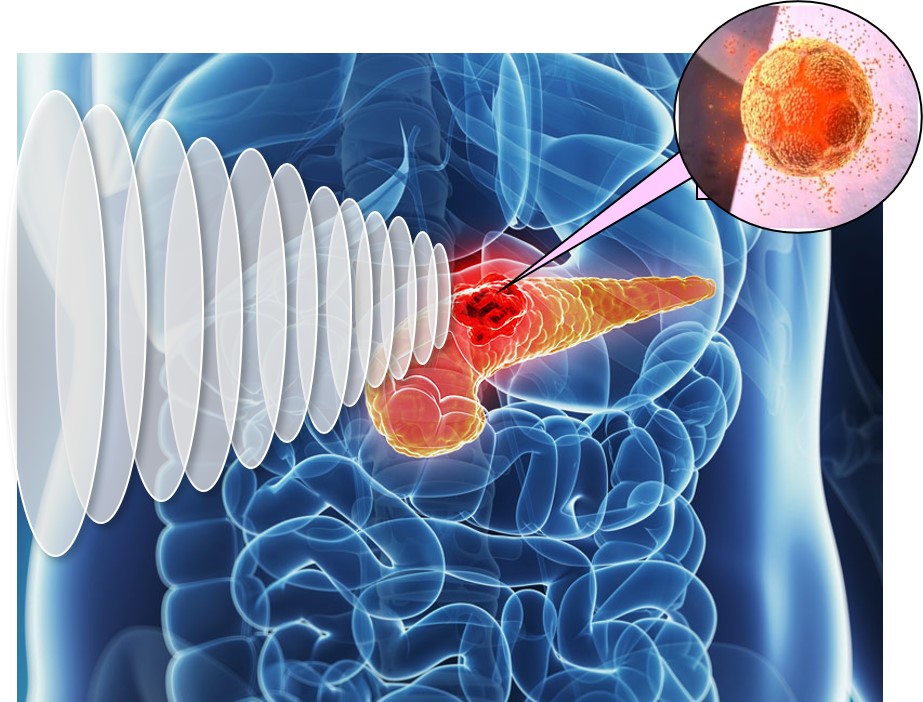 Pancreatic Adenocarcinoma Ultrasound